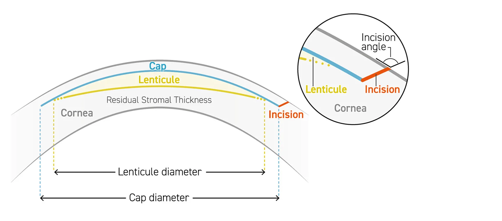 SmartSight – minimally invasive lenticule extraction | SCHWIND - Schwind